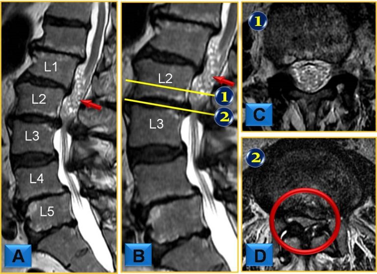 The Mystery of Redundant Nerve Roots of Cauda Equina Has Finally Been ...