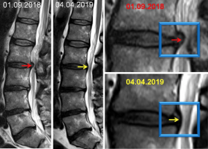 The Mystery of Redundant Nerve Roots of Cauda Equina Has Finally Been ...