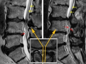 The Mystery of Redundant Nerve Roots of Cauda Equina Has Finally Been ...