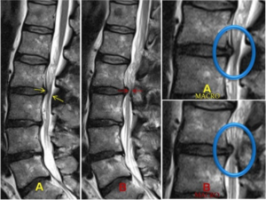 The Mystery of Redundant Nerve Roots of Cauda Equina Has Finally Been ...