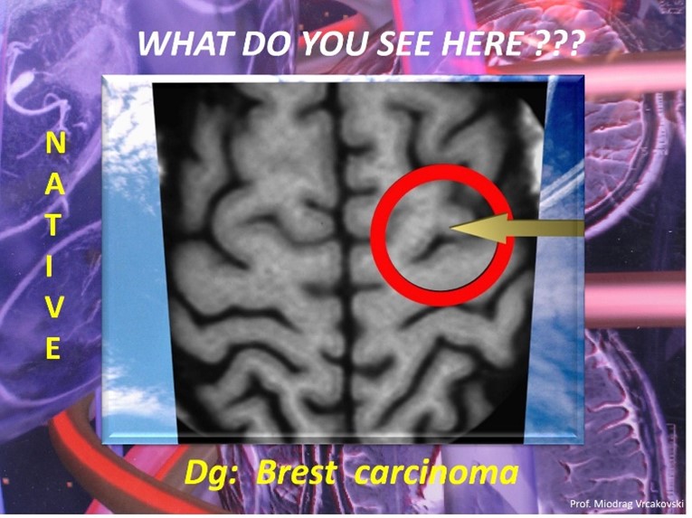 MRI CONTRAST AGENTS IN NEURORADIOLOGY – HOW THEY ACT! – Easy Neuroradiology