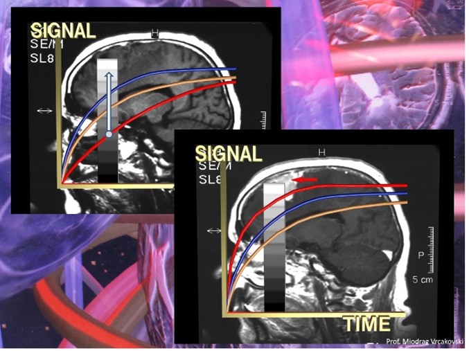 MRI CONTRAST AGENTS IN NEURORADIOLOGY – HOW THEY ACT! – Easy Neuroradiology