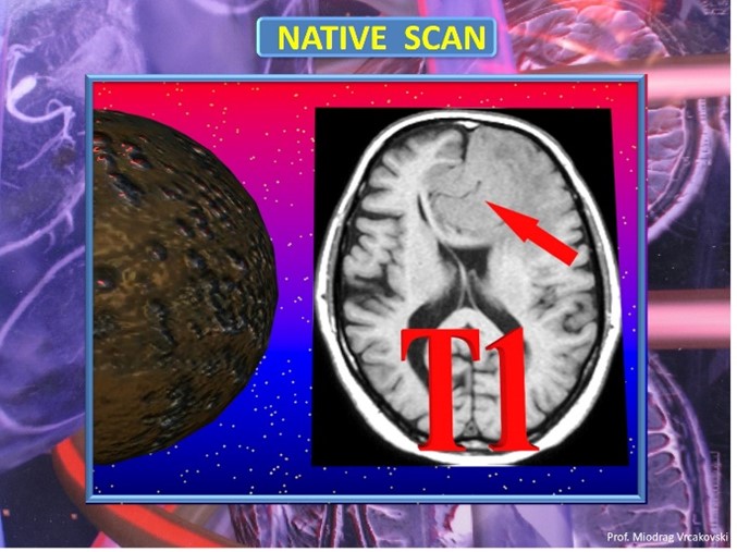 MRI CONTRAST AGENTS IN NEURORADIOLOGY – HOW THEY ACT! – Easy Neuroradiology