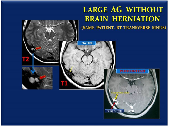 BRAIN HERNIATION INTO THE TRANSVERSE VENOUS SINUS DUE TO GIANT ...
